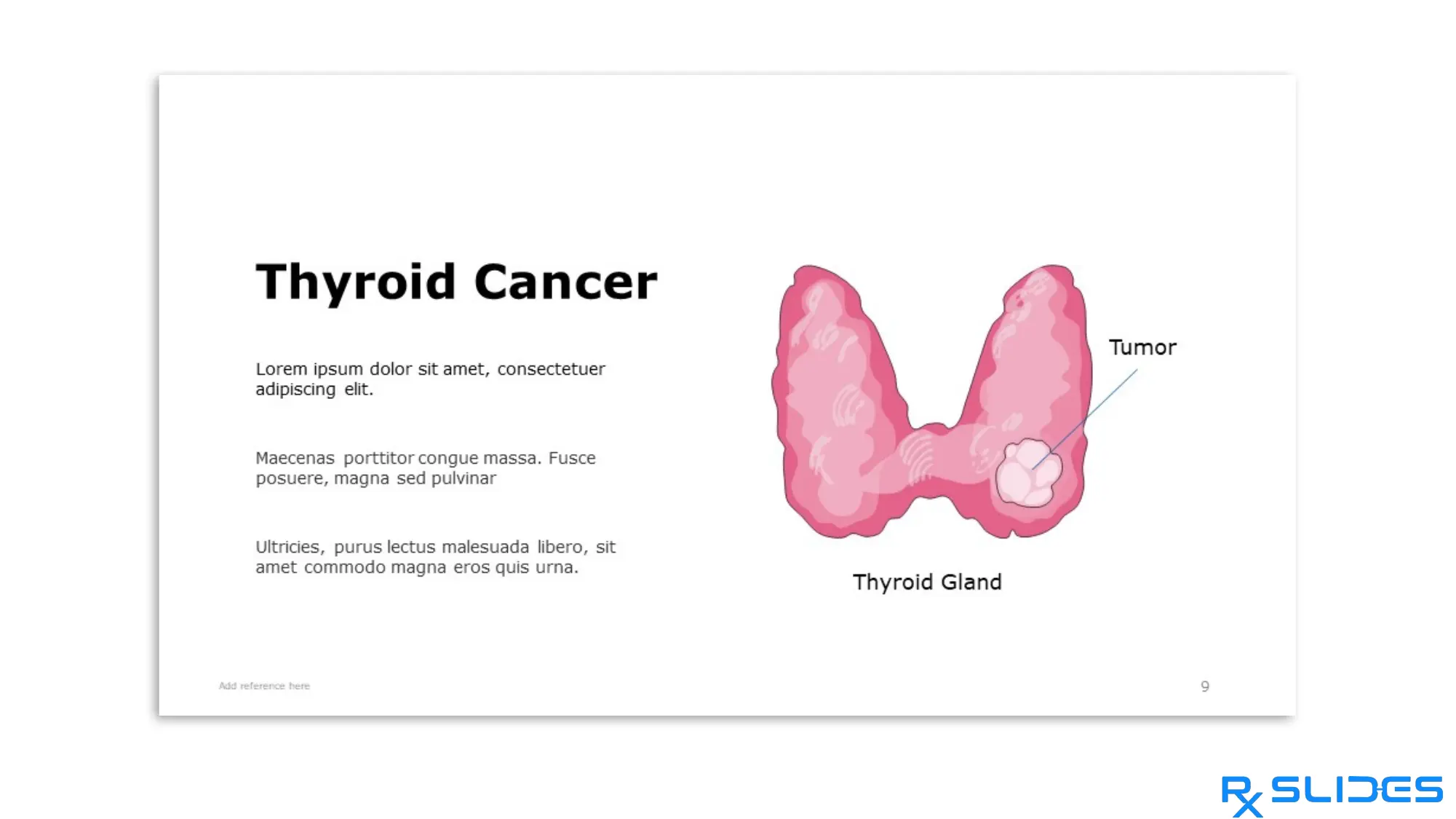 Download Thyroid Cancer PowerPoint Template|RxSlides